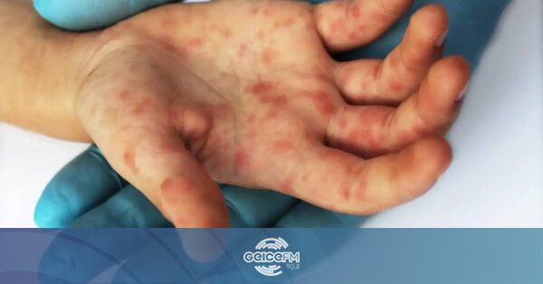 Monkeypox: Número de casos confirmados em Portugal sobe | Rádio Geice